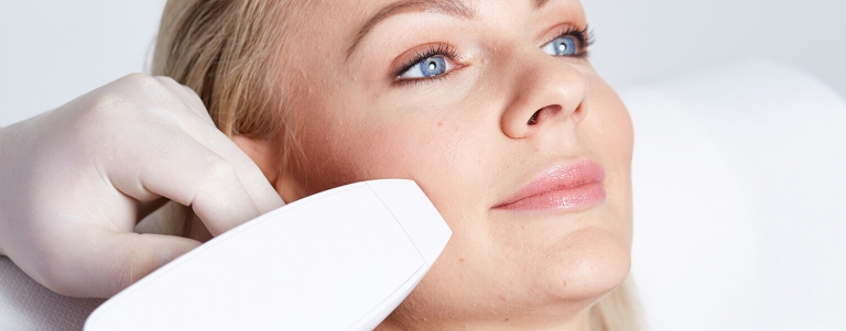 Aknenarben entfernen Linz Laserbehandlung, Aknenarben lasern Linz